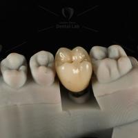 China Cement Retained Zirconia Implant Crown And Bridge CAD/CAM Dental Lab for sale