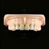 China Co-Cr Alloy PFM Crown & Bridge  China Dental Lab for sale