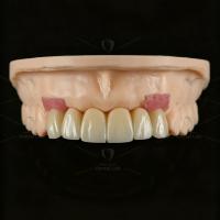 China Multilayered Full Zirconia Screw-Retained Bridge, Customizable, for Anterior Implant Restoration for sale