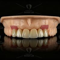 China Multilayered Full Zirconia Screw-Retained Bridge, Customizable, for Anterior Implant Restoration for sale