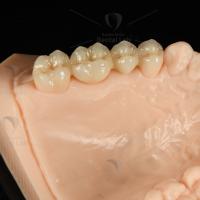 China CAD/CAM Dental Zirconia Crown & Bridge,  Zirconia Restoration for sale