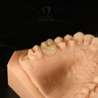 China China Dental Lab Full Zirconia Crown | All Ceramic Dental Restoration for sale