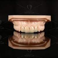 China Lithium Disilicate Emax Veneer | Cast Ceramic Veneer for sale