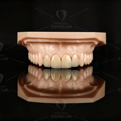 China Lithium Disilicate Emax Veneer | Cast Ceramic Veneer for sale