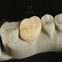China Cobalt-Chromium Post & Core with Multi-Layer Zirconia Full Crown for sale