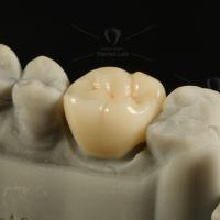 China Cobalt-Chromium Post & Core with Multi-Layer Zirconia Full Crown for sale