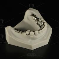 China Custom Ultra-Thin Biocompatible Dental Metal Framework for Removable Partial Denture and Metal Partial Denture Restoration for sale