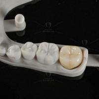 China Multilayer Zirconia Full Ceramic Crown Customizable Zirconia Restorations for sale