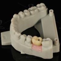 China China Dental Lab One-Piece Integrated Implant Crown for sale