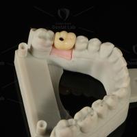 China China Dental Lab One-Piece Integrated Implant Crown for sale