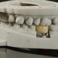 China China Dental Lab One-Piece Integrated Implant Crown for sale