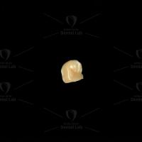 China China Dental Lab IPS e.max Lithium Disilicate Inlay & Onlay for sale