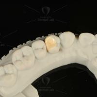 China China Dental Lab IPS e.max Lithium Disilicate Inlay & Onlay for sale