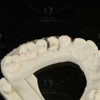 China China Dental Lab IPS e.max Lithium Disilicate Inlay & Onlay for sale