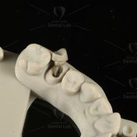 China Cobalt-Chromium Post & Core with Layered Zirconia Full Crown for sale