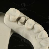 China Cobalt-Chromium Post & Core with Layered Zirconia Full Crown for sale