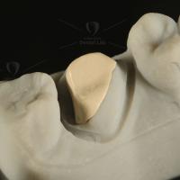 China Biocompatible Corrosion Resistant Post and Core with Strong Retention Zirconia Crown for sale