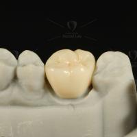 China Biocompatible Corrosion Resistant Post and Core with Strong Retention Zirconia Crown for sale