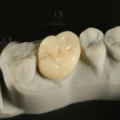 China Biocompatible Corrosion Resistant Post and Core with Strong Retention Zirconia Crown for sale