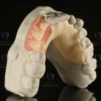 China PEEK Removable Partial Denture | Metal-Free & Comfort RPD for sale