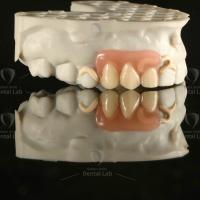 China PEEK Removable Partial Denture | Metal-Free & Comfort RPD for sale