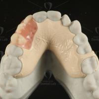 China PEEK Removable Partial Denture | Metal-Free & Comfort RPD for sale
