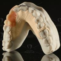 China PEEK Removable Partial Denture | Metal-Free & Comfort RPD for sale