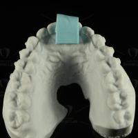 China Custom Lingual Twist Wire Retainer for Post-Ortho Treatment for sale