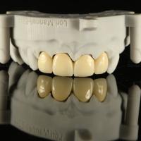 China Multi-Layer Zirconia Crown – Natural & Durable for sale