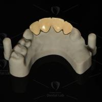 China Multi-Layer Zirconia Crown – Natural & Durable for sale