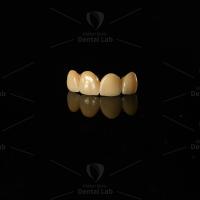 China Multi-Layer Zirconia Crown – Natural & Durable for sale