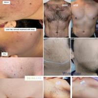 China Permanent Hair Removal Diode Laser Machine 1200W For All Skin Types for sale
