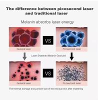 China Picolaser Laser Tattoo Removal Machine with 2000W Q Switched Nd Yag for sale