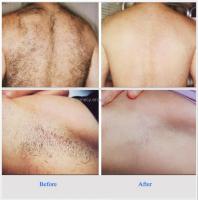 China 808 755 940 1064nm Diode Laser Hair Removal Machine 2000w Laser Depilation Machine for sale