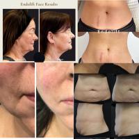 China Non Surgical Liposuction Machine For Skin Tightening Fat Removal for sale