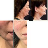 China Skin Tightening Fat Removal EVLT Machine 15W 20W Diode Laser Therapy Device for sale