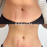 China Fat Reduction Endolift Laser Machine 15W 20W 1470nm Cellulite Reducer Machine for sale