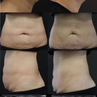 China Diode Laser Vascular Removal Machine Endolift Varicose Vein Machine for sale