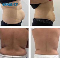 China 5 Wavelengths Lipolaser Slimming Machine Treatment Time 1-60mins for sale