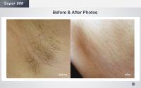 China 1-120J/CM2 180J/CM2 Diode Laser Machine 1000W 1600W Hair Removal Skin Rejuvenation Machine for sale