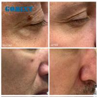 China Vaginal Rejuvenation CO2 Fractional Laser System With Scanning Speed More Than 10m/S for sale