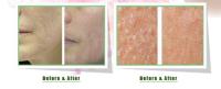 China 1550nm Diode Erbium Laser Machine Glass Fractional Laser Skin Resurfacing Equipment for sale