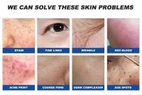 China 2mj~150mj Er Yag Laser Machine Stretch Mark Removal Laser Machine For Skin Rejuvenation for sale