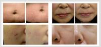 China Skin Resurfacing Er Yag Laser Machine Super Penetration Wrinkle Removal Device for sale