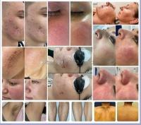 China M22 Opt Permanent Laser Hair Removal Machine with Cooling and Skin Tightening Feature for sale