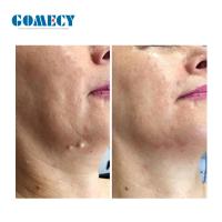 China 110V 220V Fractional CO2 Laser Machine For Acne Scar Removal Repetition Rate 1-10Hz for sale