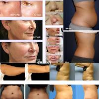 China 980nm 1470nm Liposuction Machine Fat Removal Laser Lipolysis Equipment for sale