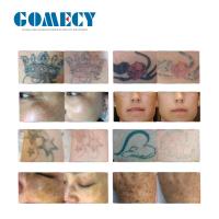 China Picosecond Laser Tattoo Removal Machine , Nd Yag Q Switch Laser Machine for sale