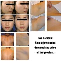China IPL 2 Handles Skin Rejuvenation Acne Treatment Vascular Hair Removal Machine for sale
