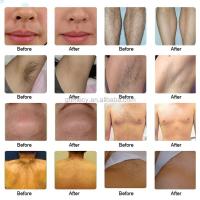 China 12x18mm2/12*28mm Spot Size 808nm Diode Laser Hair Removal Machine Painless for sale